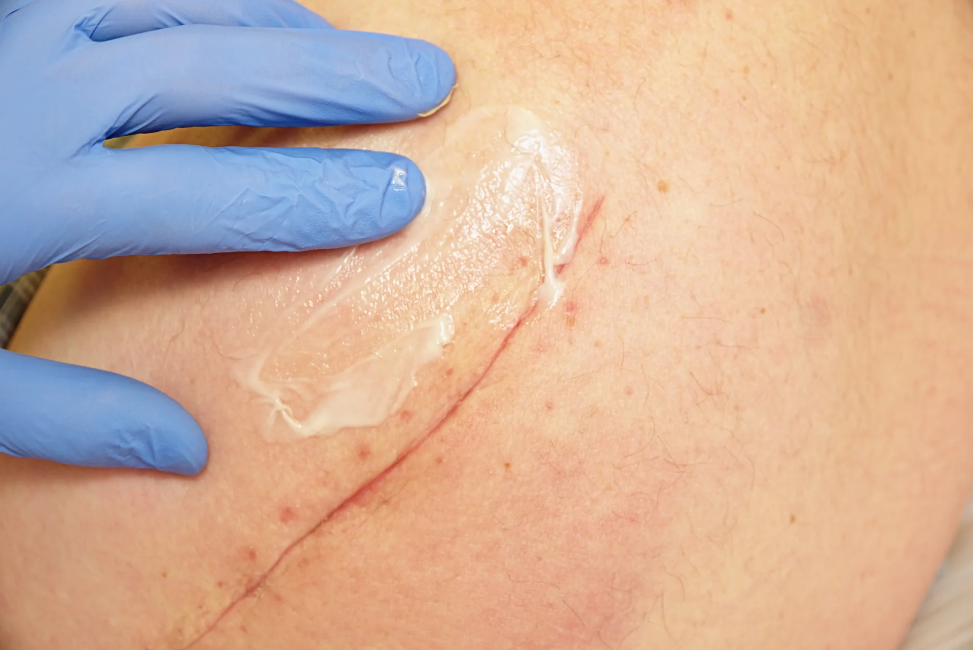 From Cuts to Surgery: When to Start Using an Anti-Scar Ointment